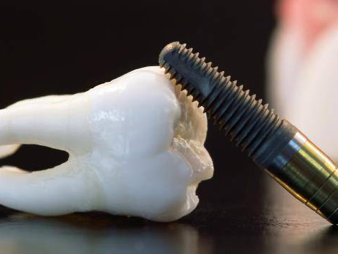 Implantologie - Liz Dent - Cabinet Stomatologic